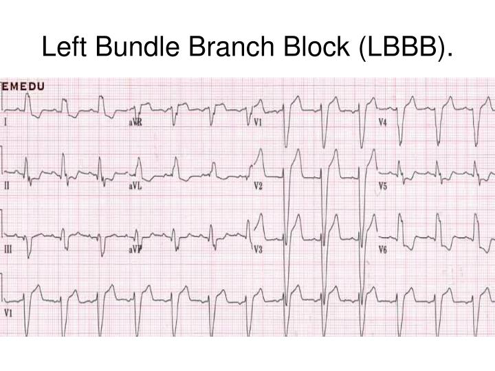 PPT - Ventricular Conduction Disorders. PowerPoint Presentation - ID ...