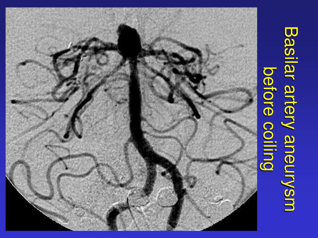 PPT - Critical care of the patient with acute subarachnoid hemorrhage ...