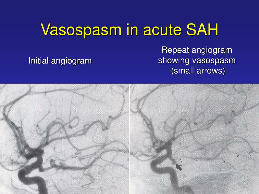 PPT - Critical care of the patient with acute subarachnoid hemorrhage ...
