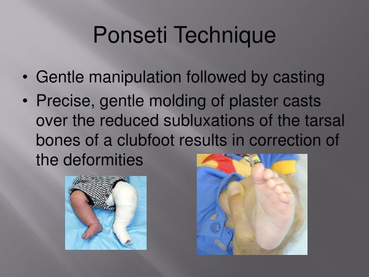 PPT - Ponseti Casting and Technique for Pediatric Clubfoot Management ...