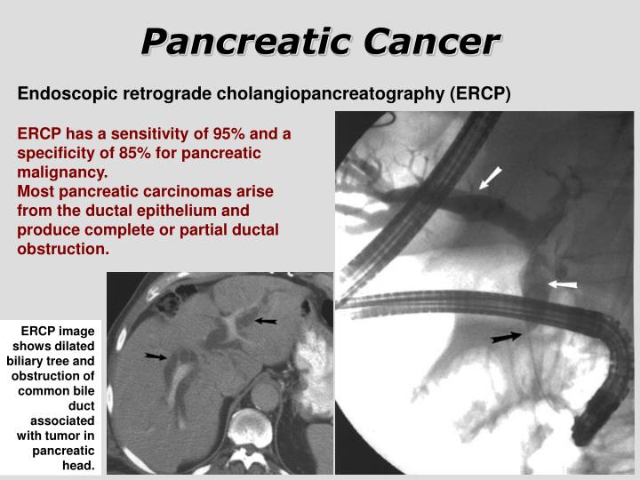 PPT - Pancreatic Cancer PowerPoint Presentation - ID:6722307