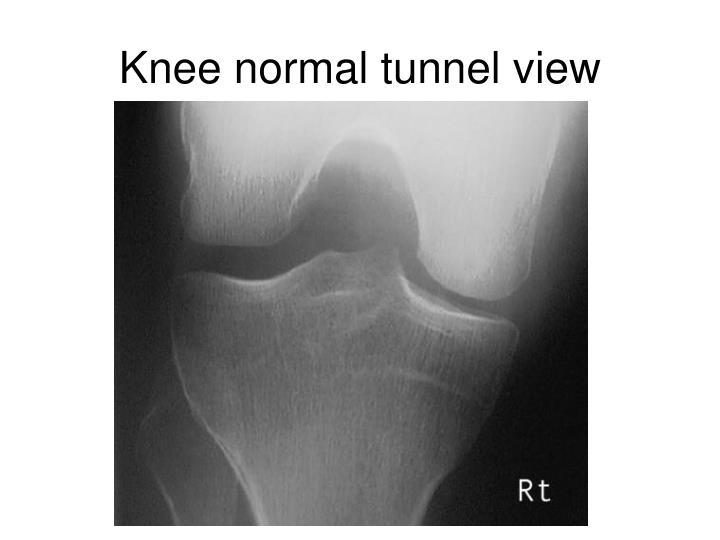 PPT - Broadies Abscess PowerPoint Presentation - ID:6723173