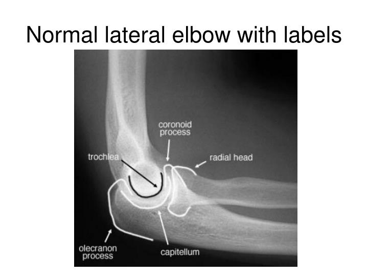 PPT - Broadies Abscess PowerPoint Presentation - ID:6723173