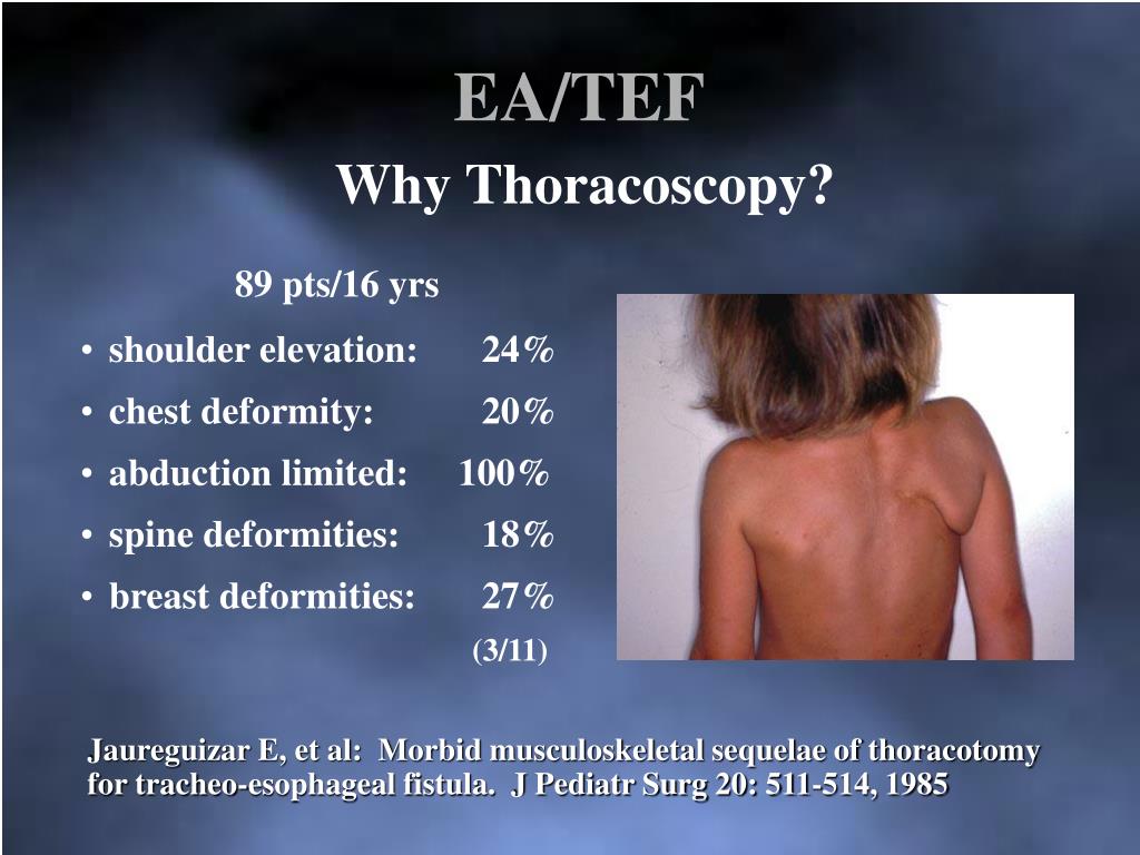 PPT - Thoracoscopic Repair of Esophageal Atresia With Tracheoesophageal ...