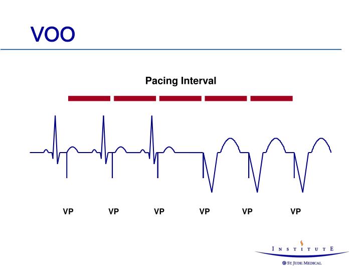 PPT - NBG Pacemaker Code PowerPoint Presentation - ID:6724840