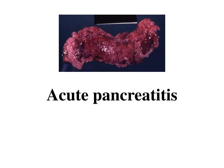 PPT - Acute pancreatitis PowerPoint Presentation, free download - ID ...