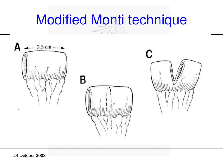 PPT - Continent Urinary Diversion PowerPoint Presentation - ID:6728732
