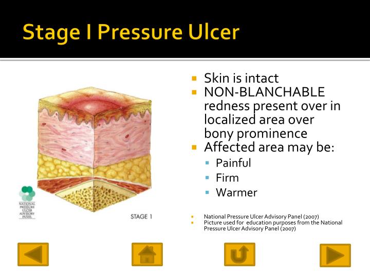 PPT - Pressure Ulcers in the Critically Ill Patient PowerPoint ...
