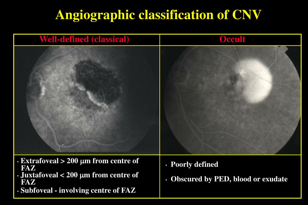 PPT - AGE-RELATED MACULAR DEGENERATION (AMD) PowerPoint Presentation ...