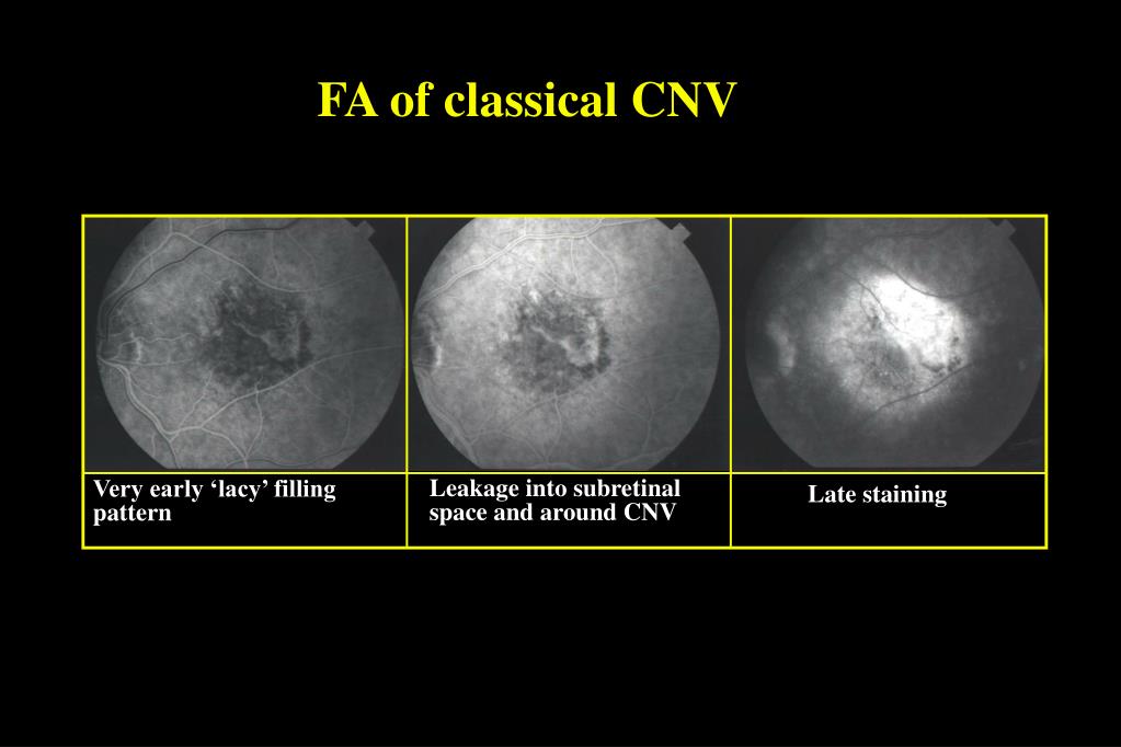 PPT - AGE-RELATED MACULAR DEGENERATION (AMD) PowerPoint Presentation ...