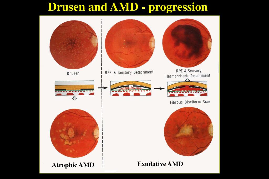 PPT - AGE-RELATED MACULAR DEGENERATION (AMD) PowerPoint Presentation ...