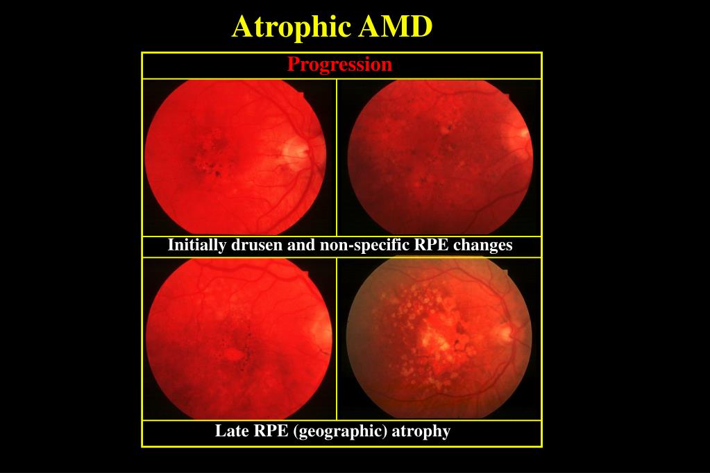 PPT - AGE-RELATED MACULAR DEGENERATION (AMD) PowerPoint Presentation ...