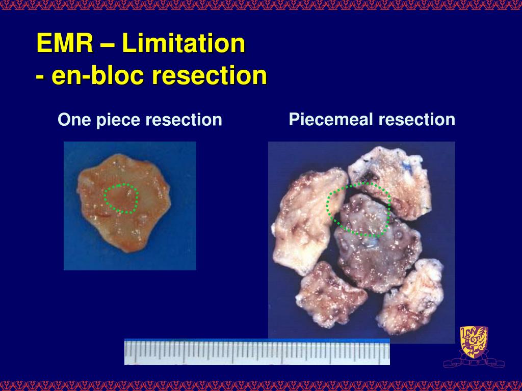 PPT - Management of Early Gastric Cancer PowerPoint Presentation, free ...