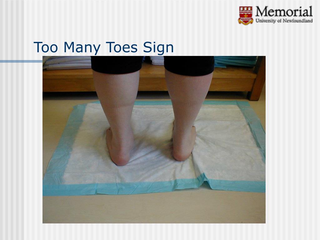 PPT - Tibialis Posterior Insufficiency PowerPoint Presentation, free ...