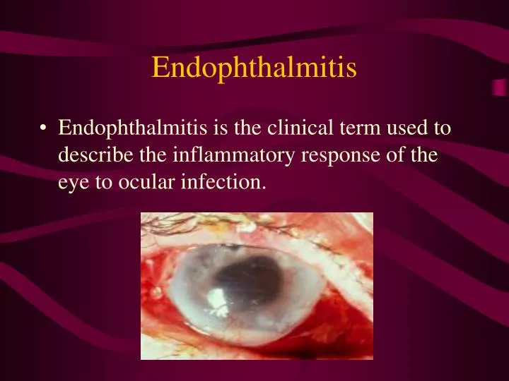 PPT - Endophthalmitis PowerPoint Presentation, free download - ID:6740253