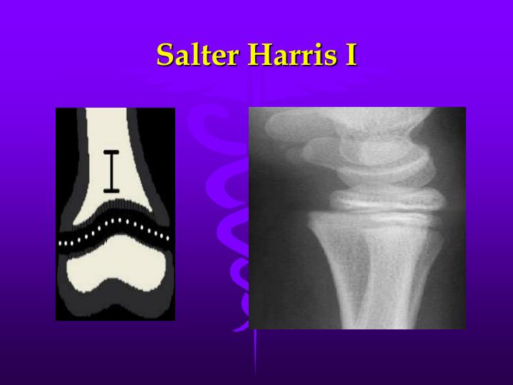 PPT - Salter Harris Fracture Classification PowerPoint Presentation ...