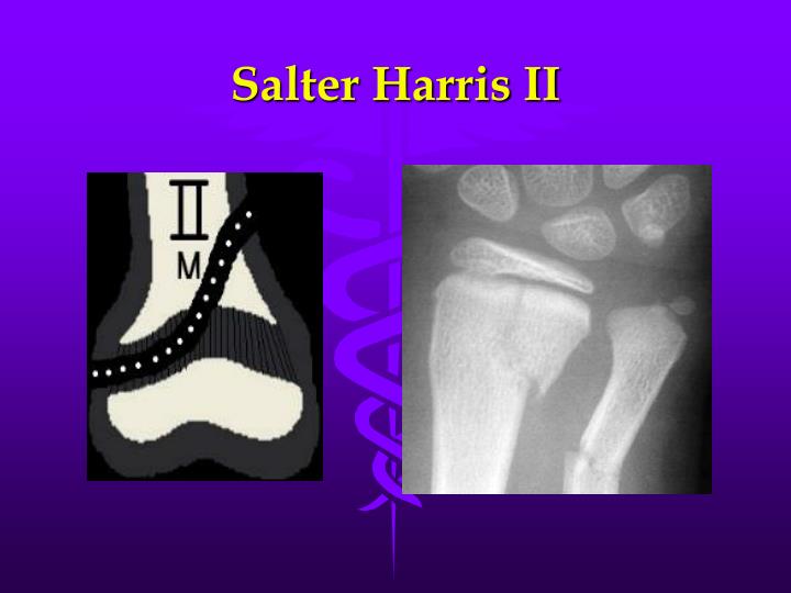 PPT - Salter Harris Fracture Classification PowerPoint Presentation ...