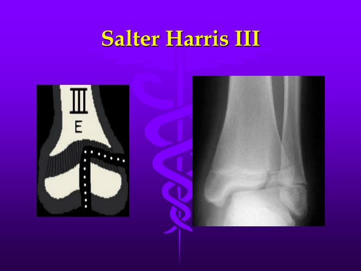 PPT - Salter Harris Fracture Classification PowerPoint Presentation ...