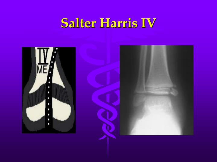 PPT - Salter Harris Fracture Classification PowerPoint Presentation ...