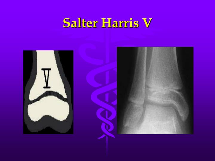 PPT - Salter Harris Fracture Classification PowerPoint Presentation ...
