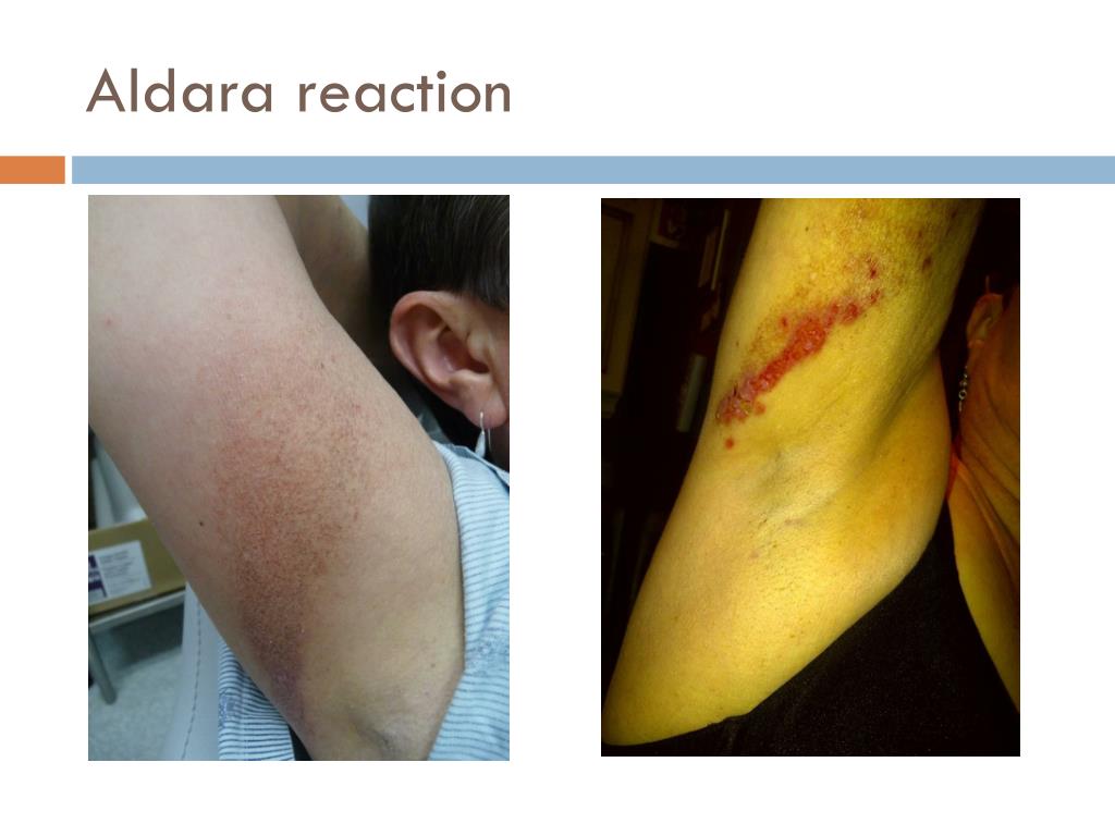 PPT - Dermatology Aspects of Cutaneous T-cell Lymphoma PowerPoint ...