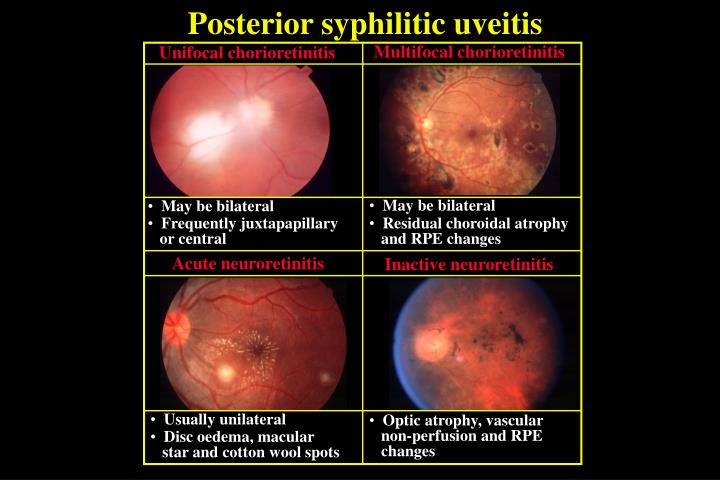 PPT - UVEAL INFECTIONS AND INFESTATIONS PowerPoint Presentation - ID ...