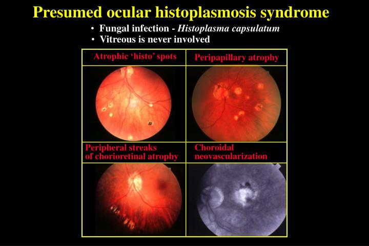 PPT - UVEAL INFECTIONS AND INFESTATIONS PowerPoint Presentation - ID ...