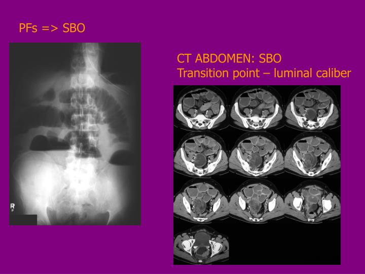 PPT - BASIC GI RADIOLOGY THE “FLAT” PLATE PowerPoint Presentation - ID ...