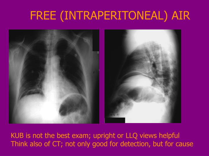 PPT - BASIC GI RADIOLOGY THE “FLAT” PLATE PowerPoint Presentation - ID ...