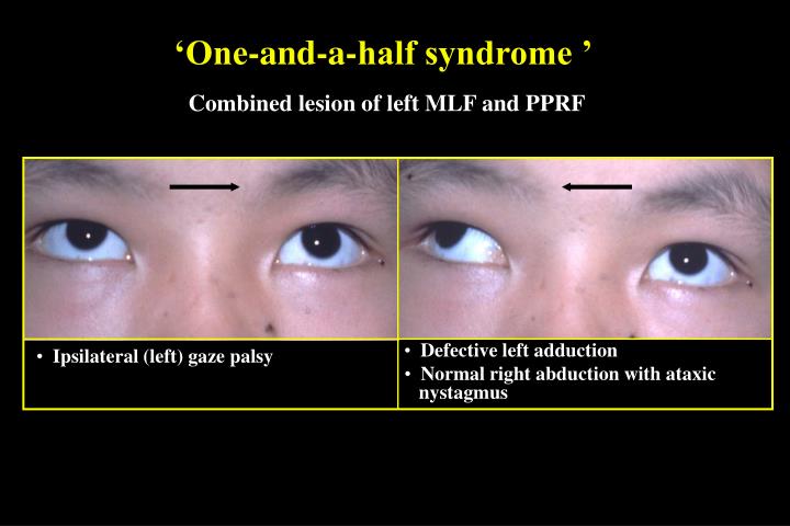 PPT - SUPRANUCLEAR DISORDERS OF EYE MOVEMENT PowerPoint Presentation ...
