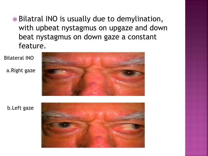 PPT - Gaze palsy PowerPoint Presentation - ID:6756865