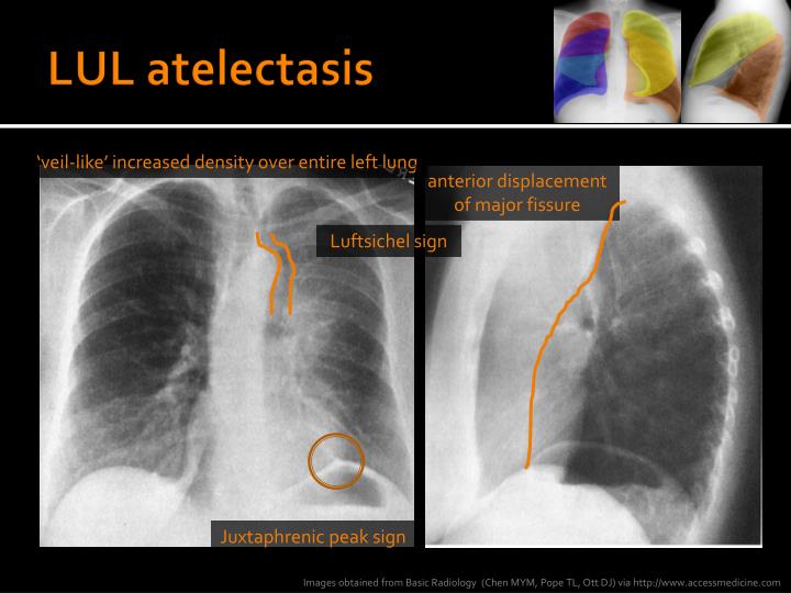 PPT - ATELECTASIS PowerPoint Presentation - ID:6757762