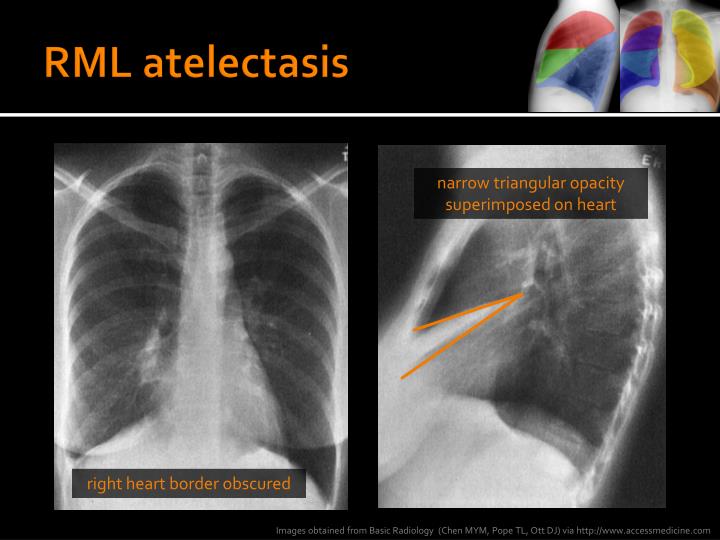 PPT - ATELECTASIS PowerPoint Presentation - ID:6757762