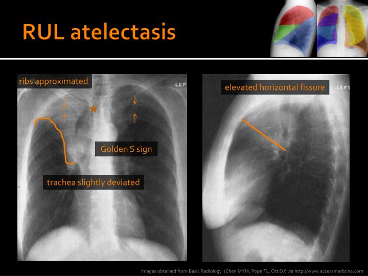PPT - ATELECTASIS PowerPoint Presentation - ID:6757762