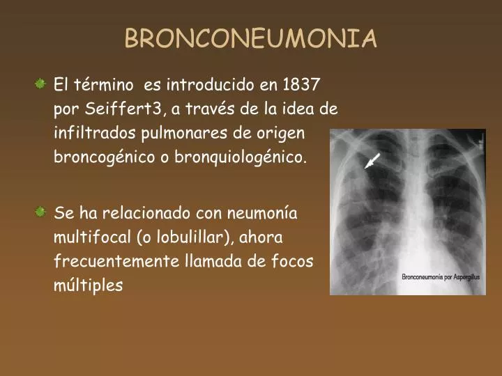 PPT - BRONCONEUMONIA PowerPoint Presentation, free download - ID:6758360