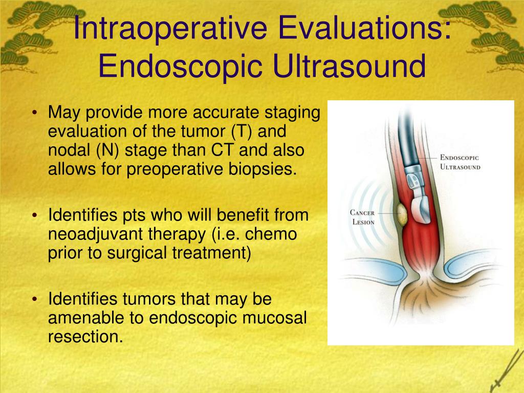 Ppt Gastric Resection General Surgical And Anesthetic Considerations