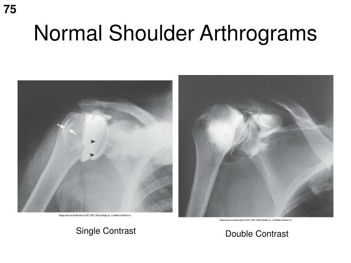 PPT - ARTHROGRAMS RT 255 PowerPoint Presentation - ID:6761291