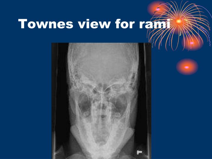 PPT - MANDIBLE, SINUSES, TEMPORAL BONE PowerPoint Presentation - ID:6762618