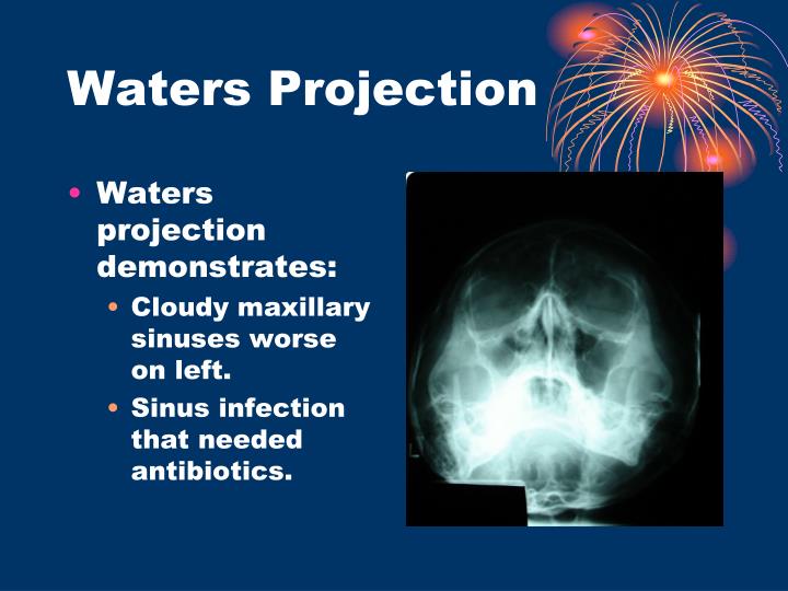 PPT - MANDIBLE, SINUSES, TEMPORAL BONE PowerPoint Presentation - ID:6762618