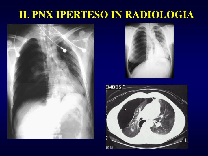 PPT - Pneumotorace spontaneo PowerPoint Presentation - ID:6765185
