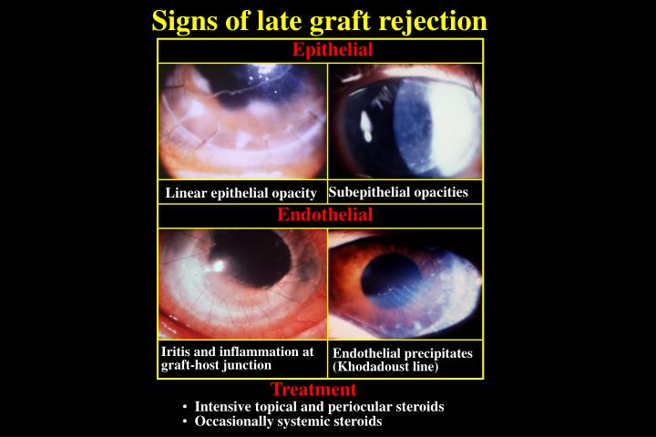 PPT - CORNEAL SURGERY PowerPoint Presentation - ID:6765684