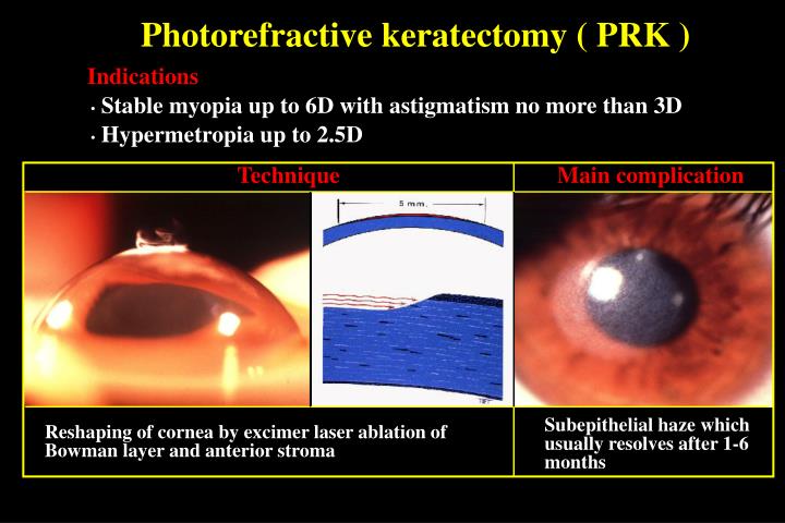 PPT - CORNEAL SURGERY PowerPoint Presentation - ID:6765684