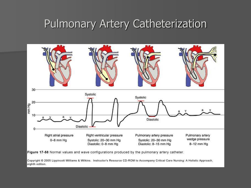 PPT - Pulmonary Artery Catheter PowerPoint Presentation, free download ...