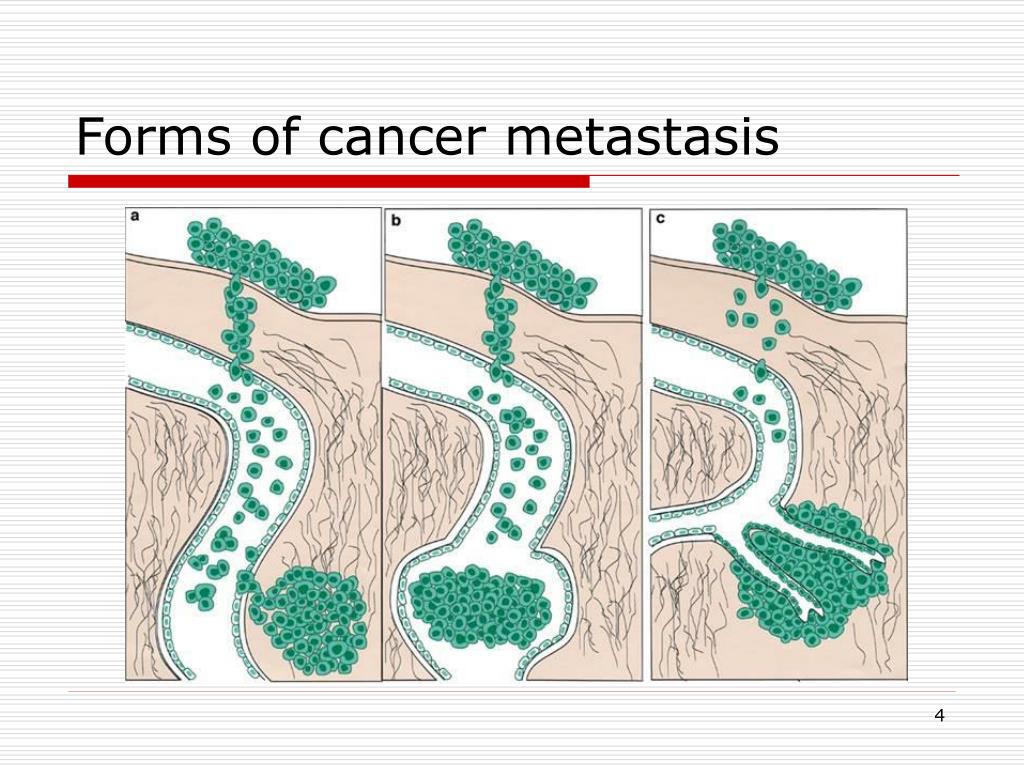 PPT - Molecular mechanism of cancer metastasis PowerPoint Presentation ... PPT - Molecular mechanism of cancer metastasis PowerPoint Presentation ...