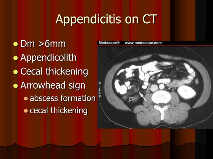 PPT - Appendicitis PowerPoint Presentation - ID:6769039