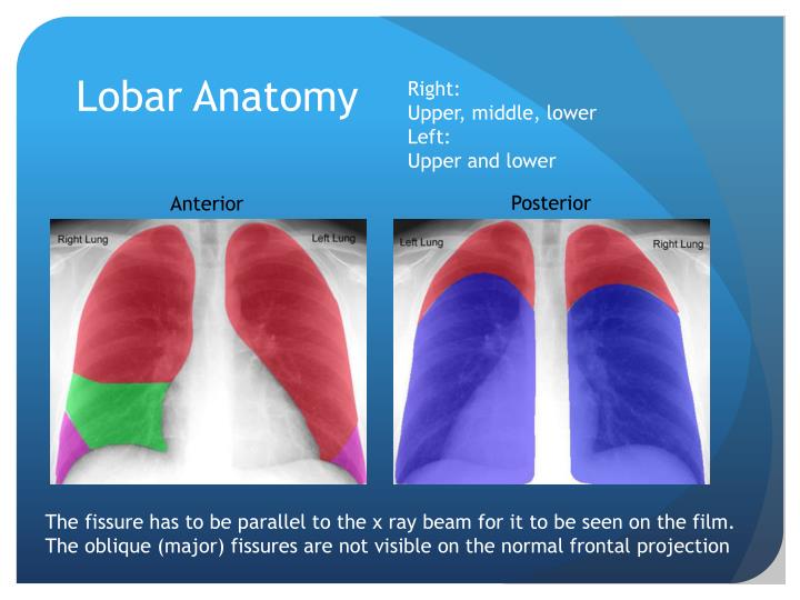 PPT - Chest X-Ray Interpretation for the Internist PowerPoint ...