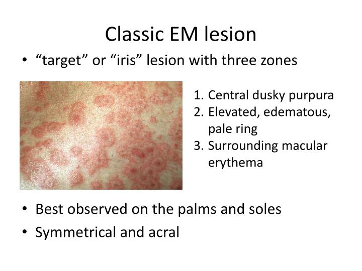 PPT - Erythema Multiforme PowerPoint Presentation - ID:6770484