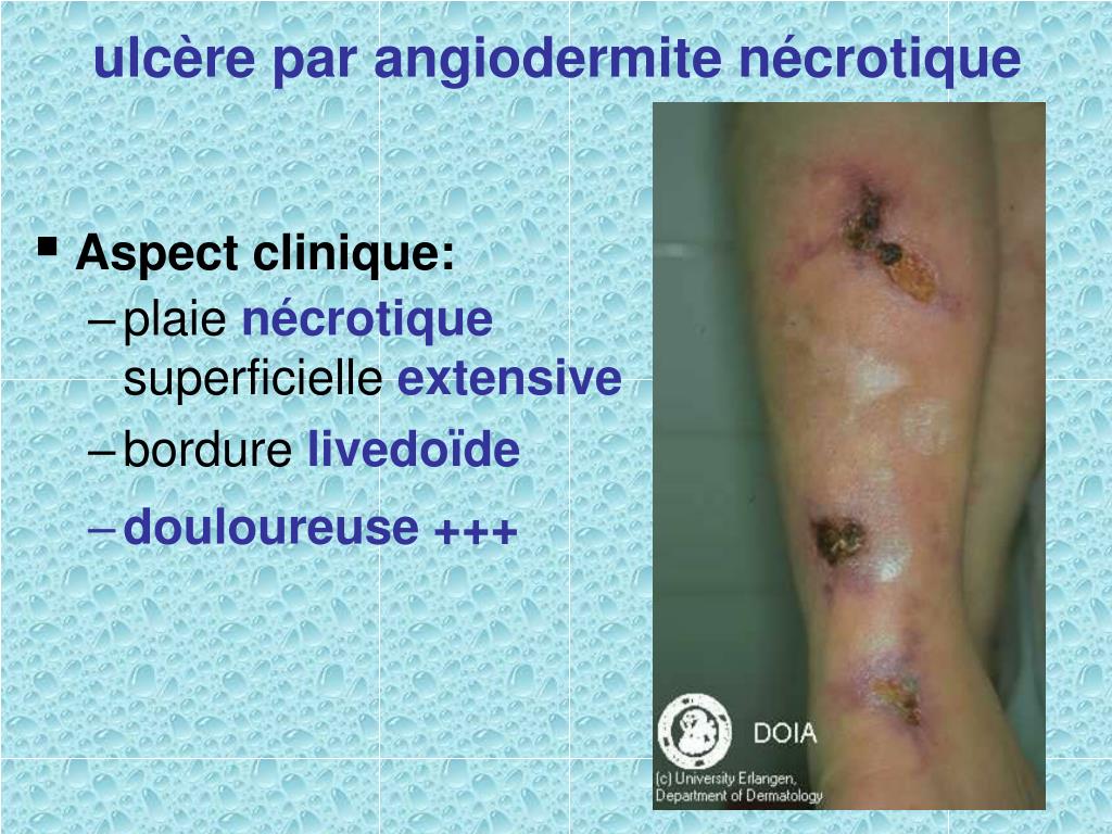 PPT - ULCERES DE JAMBE: causes, physiopathologie et diagnostic ...