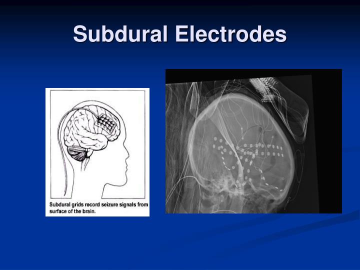 PPT - Epilepsy Surgery PowerPoint Presentation - ID:6776458