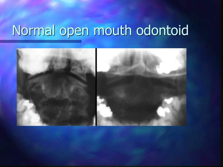 PPT - Pediatric Cervical Spine PowerPoint Presentation - ID:6786816